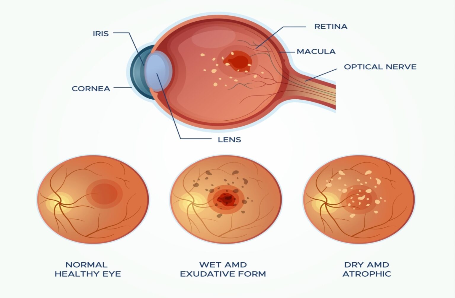 What Are the Early Warning Signs of Macular Degeneration?